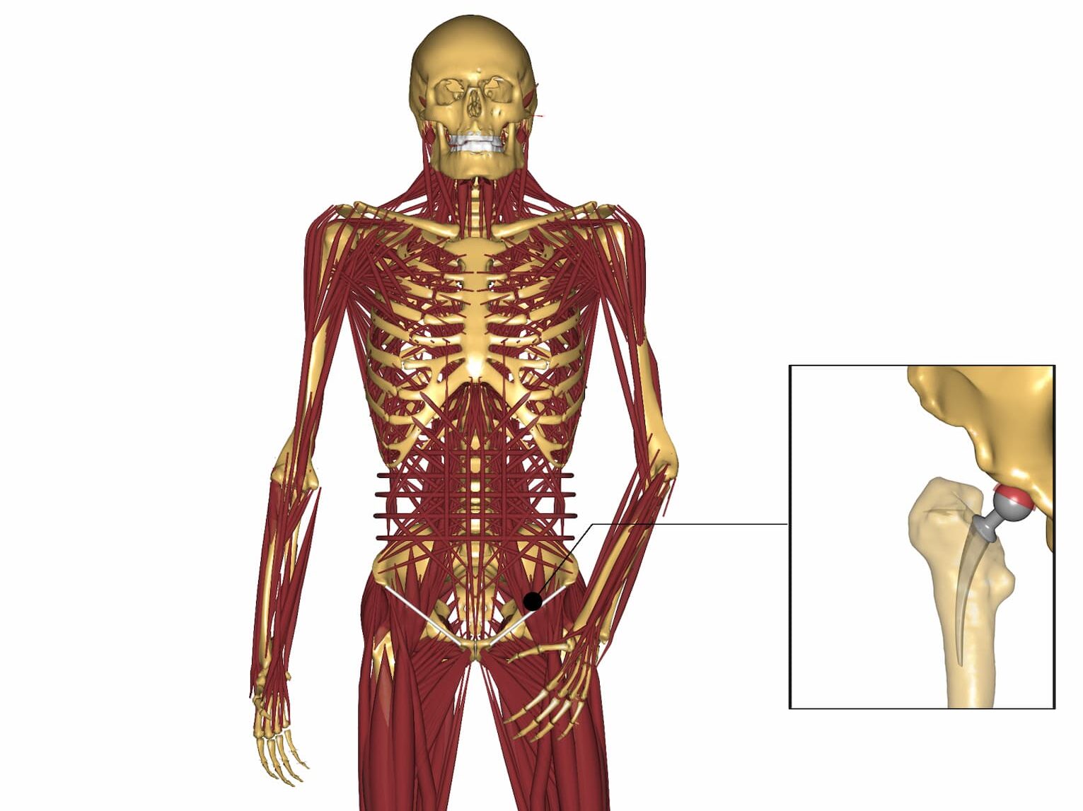 Hip implant, prosthesis, simulation, software, analysis