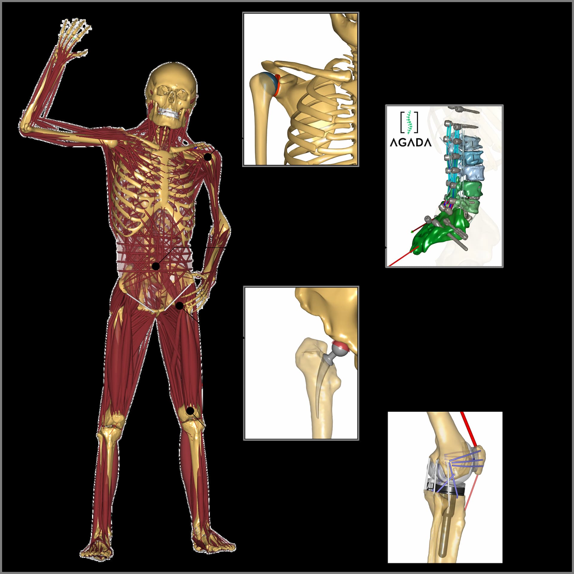 Implant design, software, simulation, motion, testing, test