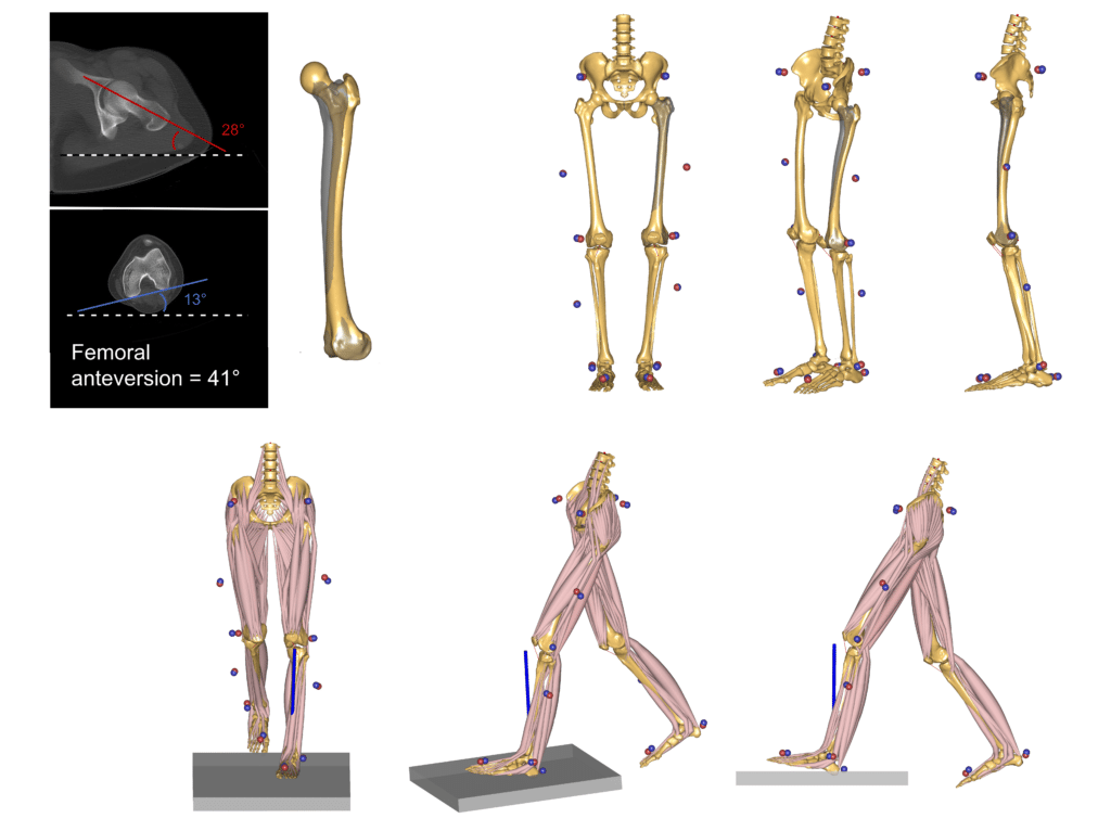 Increased femoral anteversion in children – can musculoskeletal ...
